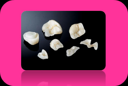 inlay-onlay-composite - EasyLab - Laboratoire Prothésiste Dentaire